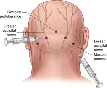 Greater Occipital Nerve Blocks & RFA | Offices in Allen & Wylie TX